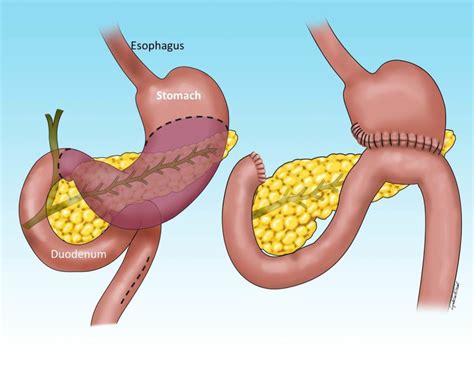 Cancer Stomach Surgery Symptoms Diagnosis Treatment Elce