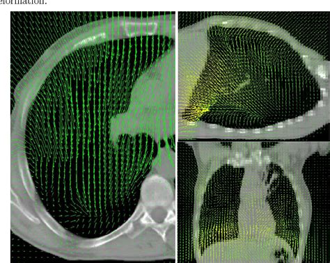 Figure 1 From Deformable Registration For Image Guided Radiation Therapy Semantic Scholar