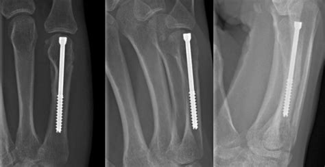 Aahs Clinical Outcomes Of Limited Open Retrograde Intramedullary Headless Screw Fixation Of