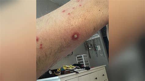 Rash After Float Tank At Irene Rayburn Blog