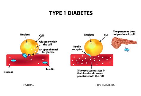 Betty Roche Exercise For Type 1 Diabetes Mellitus Management General