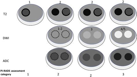 Schematic Diagram Of Pi Rads V2 1 Scoring For Tz That Incorporates Dwi Download Scientific