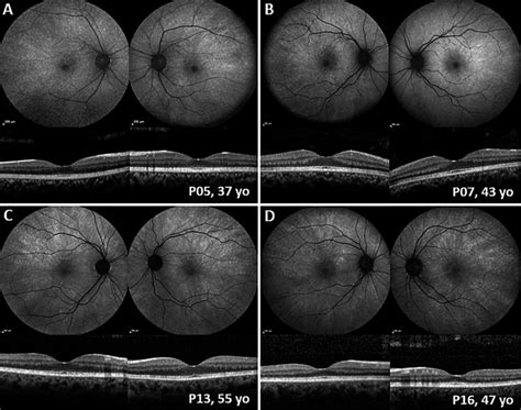 Rp2 Associated X Linked Retinopathy Clinical Findings Molecular Genetics And Natural History