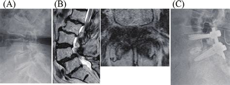 A Preoperative Plain Radiograph Showing Meyerding Grade 2 Download Scientific Diagram