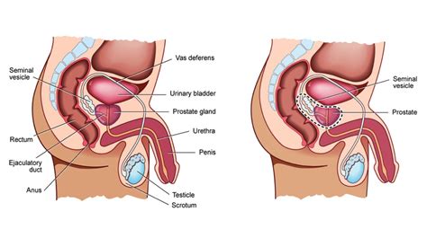 Radical Prostatectomy A Guide To Prostate Cancer Surgery