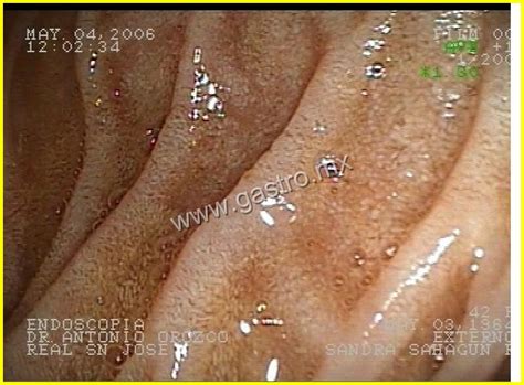 Endoscopia De Ulcera Duodenal