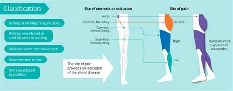 Intermittent Claudication Ic Due To Peripheral Arterial Disease Download Scientific Diagram