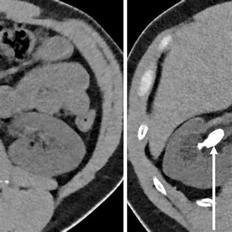 Axial Virtual Noncontrast Images From Photon Counting Ct Urograms At Download Scientific