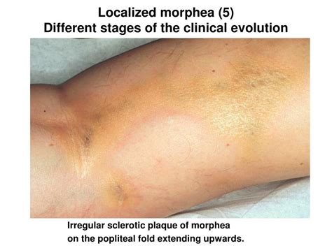 Ppt The Face In Diffuse Systemic Sclerosis Note The Radial Furrows Surrounding The Mouth
