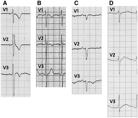 Intraventricular Conduction Delay Examples Of Ecg Recordings Showing Download Scientific