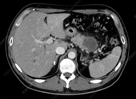 Pancreatic Carcinoma Ct Scan Stock Image C0517454 Science Photo