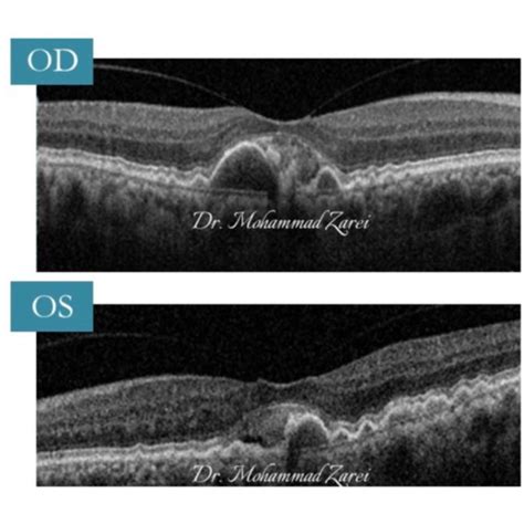 Retina Ophthalmology Mohammad Zarei