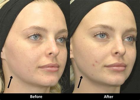 Defined Jawline Before And After