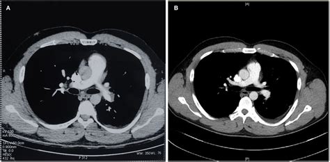 Ctpa Demonstrated Confirmed Pulmonary Embolism [ A Ctpa Scan Before