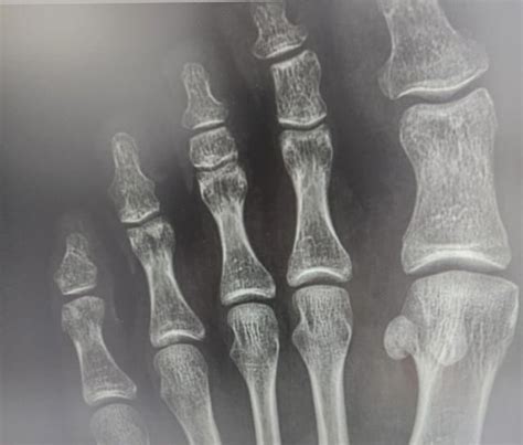 Any Difference R Xrays