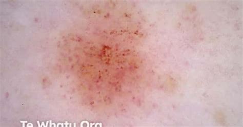 Dermoscopy Of Capillaritis Image