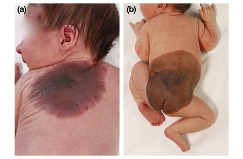 Neonatal Nevus