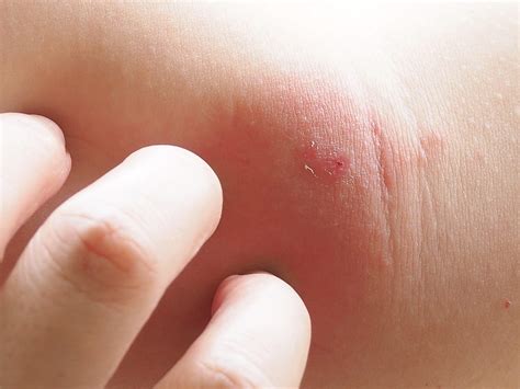 Bot Fly Larvae Human Skin