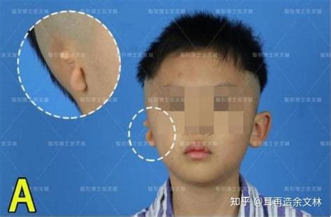 关注小耳畸形孩子心理健康耳再造重塑自信 知乎