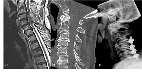 Figure 1 From Anterior Cervical Discectomy Fusion Versus Posterior Decompression And Fusion In