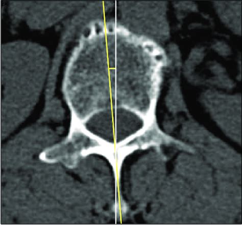 Measurement Of The Vertebral Rotation Angle Defined As The Angle