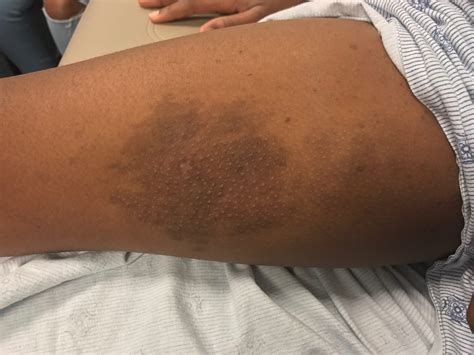 Hyperpigmented Patch On The Thigh Clinical Advisor