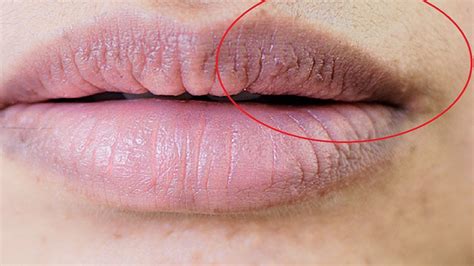 How To Get Rid Of Hyperpigmentation Around Lips Youtube How To Get Rid Of Hyperpigmentation Around Lips Youtube