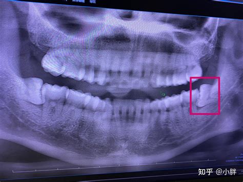 磨蹭了一年多终于拔完了第三颗智齿拔了一个月 知乎