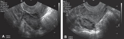 Transvaginal Ultrasound Pcos Epos™