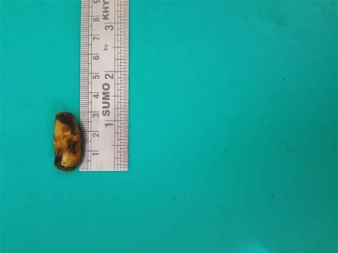 Case Of A Lady Who Had Failed ERCP With A Large CBD Stone Removed