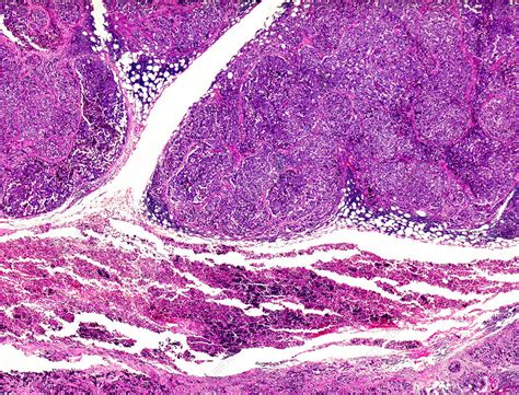 Thymoma And Thymic Carcinoma Light Micrograph Stock Image C0524973 Science Photo Library