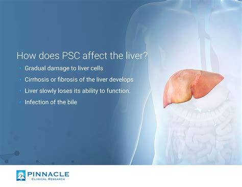 Primary Sclerosing Cholangitis PSC PDF