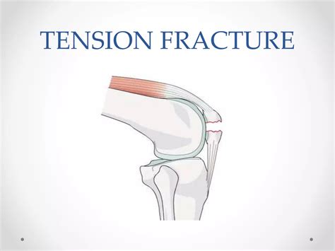 Fracture And Classification Pptx