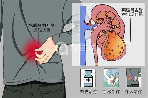 肾癌 肾癌的症状 治疗 预防 护理 爱医医疾病百科