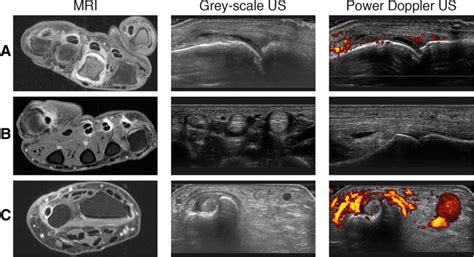 Examples Of Mri Detected Synovitis And Tenosynovitis With Corresponding
