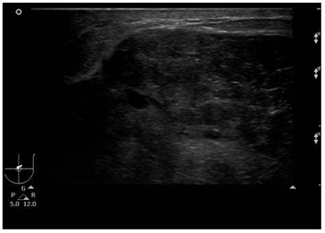 Ultrasound Of Benign Phyllodes Tumor In Left Breast Download