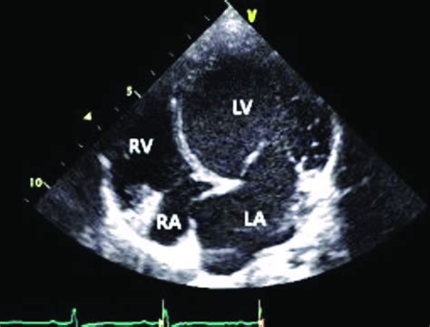 Dilated Cardiomyopathy Echo