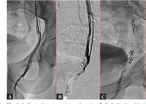 Figure 1 From Selecting Patients For Embolization Of Varicoceles Based On Ultrasonography