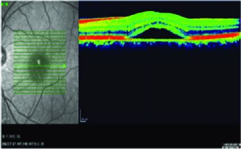Autofluorescence And Oct Findings Of Fluid Accumulation In Acute Cscr Download Scientific