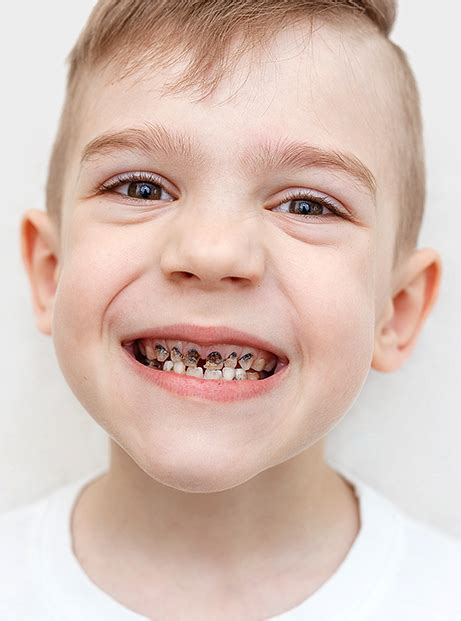 Кариес у детей лечение и профилактика в СПб Клиника «Матисс Дент