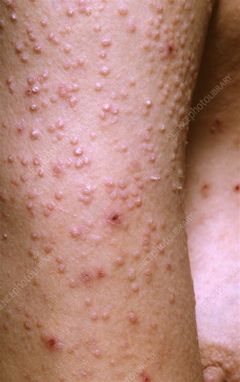 Amyloidosis Stock Image C0595282 Science Photo Library