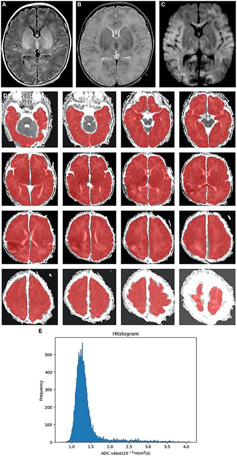 Frontiers Whole Volume Adc Histogram Of The Brain As An Image Biomarker In Evaluating Disease