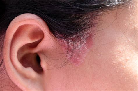 Psoriasis Forehead