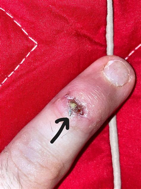 Extensor Tendon Injury After Work Accident Not Really Graphic R