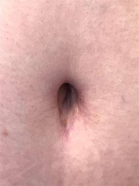 Belly Button Before And After Photos Page 2 Oppenheimer Plastic Surgery