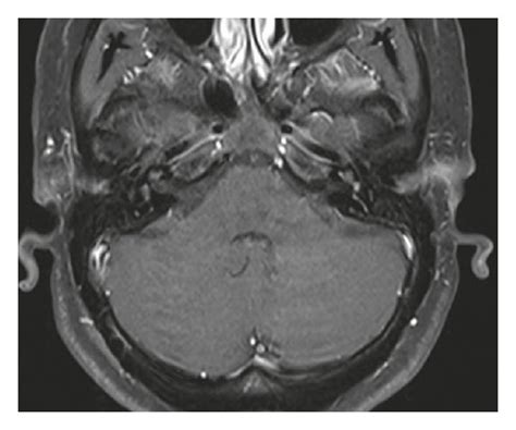Mri T1 Axial Postcontrast Imaging Demonstrating Bilateral Enhancement
