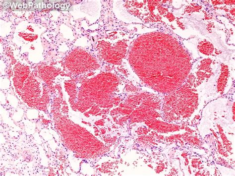 Myxoid Liposarcoma Microscopic