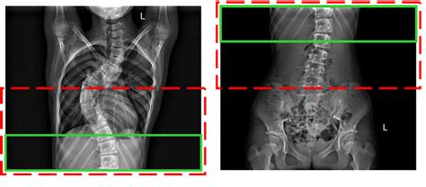 Figure 1 From Improvement Of Automated Image Stitching System For Dr X Ray Images Semantic Scholar