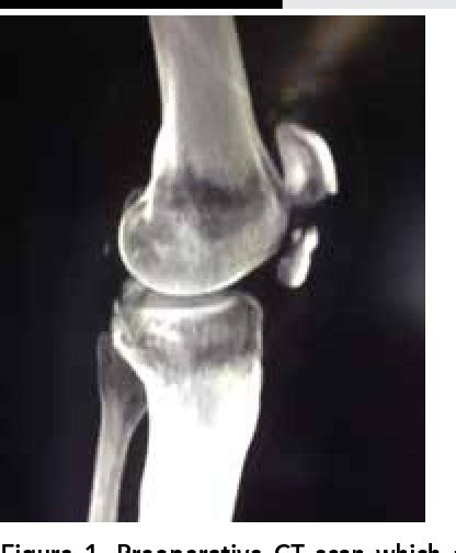 Partial Excision Of Patella Semantic Scholar