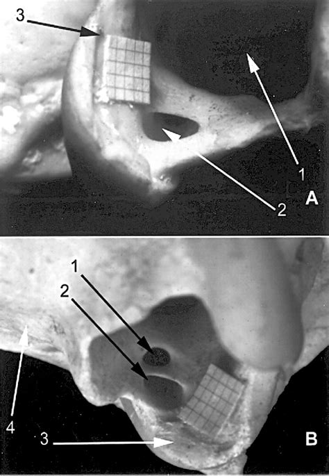 Structure Of Hypoglossal Canal Semantic Scholar
